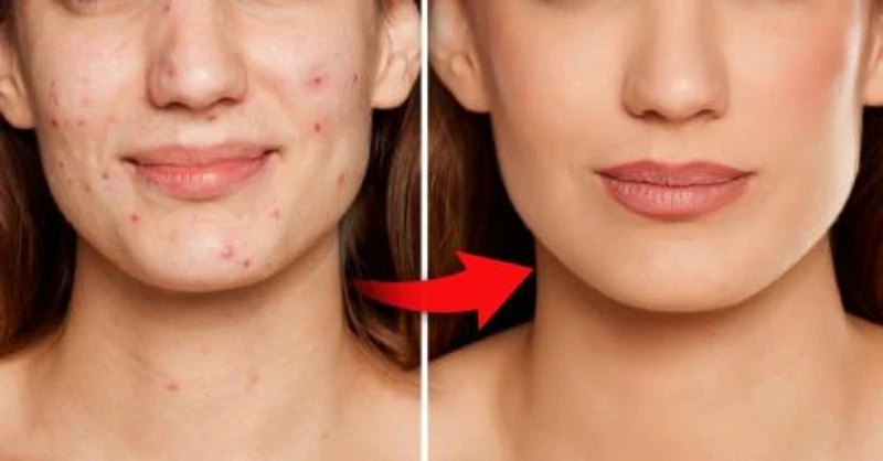 Consejos para evitar el acné y tener un mejor cutis - Lancelot Digital ...